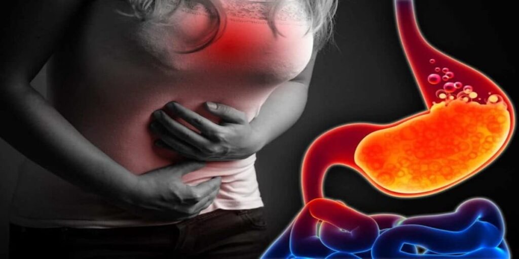 Gastro-Oesophageal Reflux Disease (GORD)